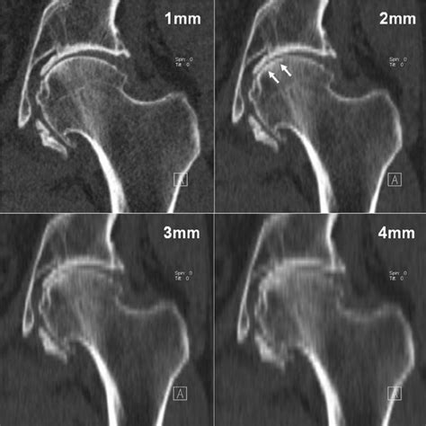 The Centrum Collum Diaphyseal Ccd Angle Is Measured On Download Scientific Diagram