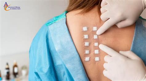 Understanding Allergy Patch Testing Everything You Need To Know