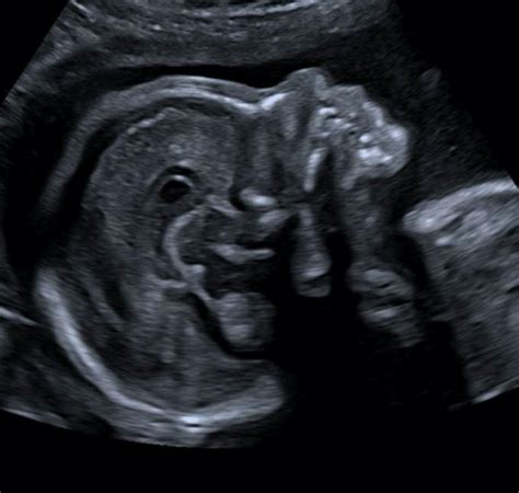 Sage Femme Échographie Thionville Victoria Beck Réalisation Déchographies Obstétricales Et