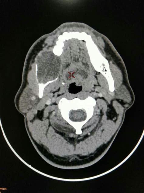 Ameloblastoma Diagnostic Imaging Radiology Head And Neck
