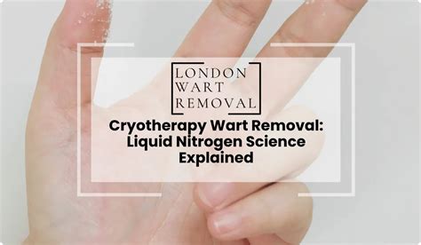 Cryotherapy Wart Removal Liquid Nitrogen Science Explained London Wart Removal Clinic