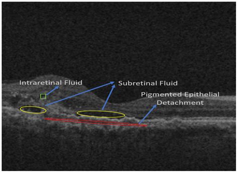 Various Pathologies Of Interest That Are Observed In Oct Images Irf