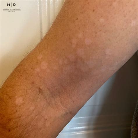 Mild Tinea Versicolor