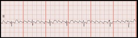Practice Ekg Rhythm Strips 117
