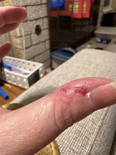 Derm Says She Cant See Wart Tissue Rwarts