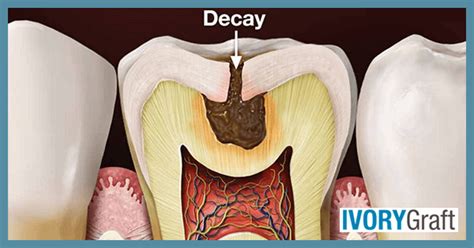 Dentin Decay And Prevention Ivory Graft