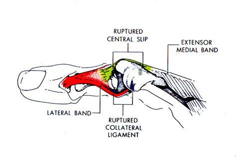 Dislocation Finger Proximal Interphalangeal Pip Joint Hand Surgery