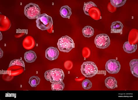 Acute Lymphocytic Leukemia All Isometric View 3d Illustration Stock