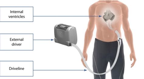 The Total Artificial Heart Thoracic Key
