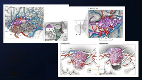 186 Resection Of An Intramedullary Spinal Arteriovenous Malformation With An Intranidal
