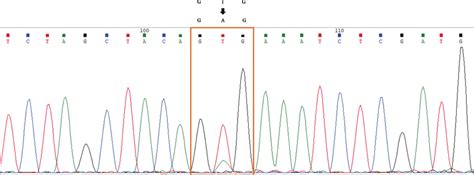 Braf V600e Mutation Analysis Direct Dna Sequencing Data From The Bone Download Scientific