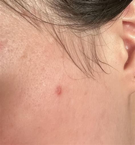 Does This Look Like Melanoma Rmelanoma Does This Look Like Melanoma Rmelanoma