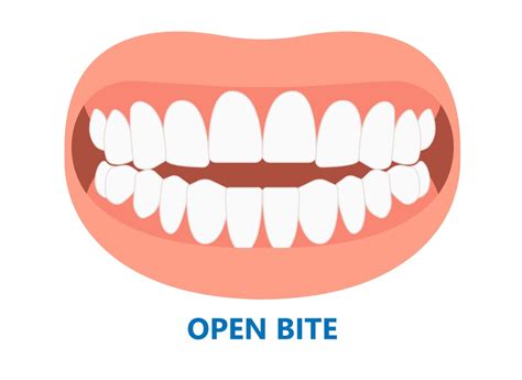 Traditional Braces Orland Park Orthodontics