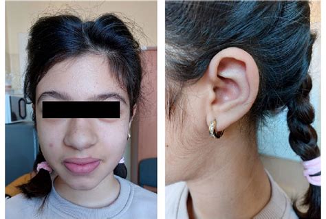 Features Of Facial Dysmorphia Present In The Patient Download Scientific Diagram