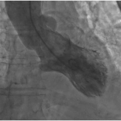 Ventricular Angiography Showing Apical Ballooning Download