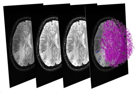 Vein Segmentation