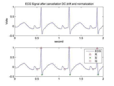 Abnormal Ecg Signal When Heart Rate 89min Download Scientific Diagram