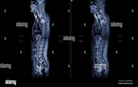 An Mri Of The Whole Spine Image Is A Comprehensive Visual