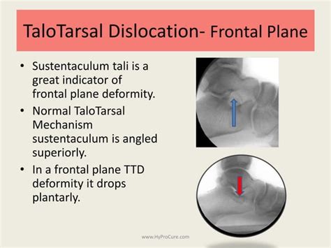 Talotarsal Dislocation Radiographic Evidence Pptx