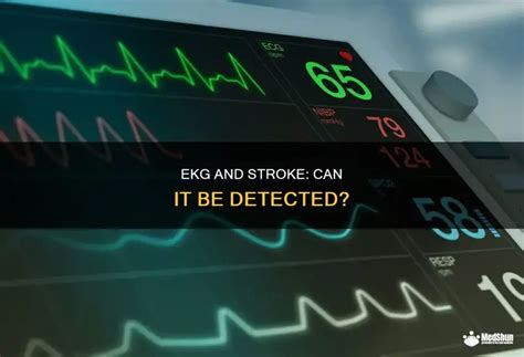 Ekg And Stroke Can It Be Detected Medshun