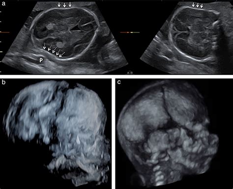 Three‐dimensional Ultrasound Imaging Of The Fetal Skull And Face
