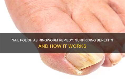 Nail Polish As Ringworm Remedy Surprising Benefits And How It Works