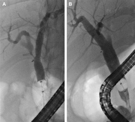 Postcholecystectomy Biliary Stricture Before A And After B