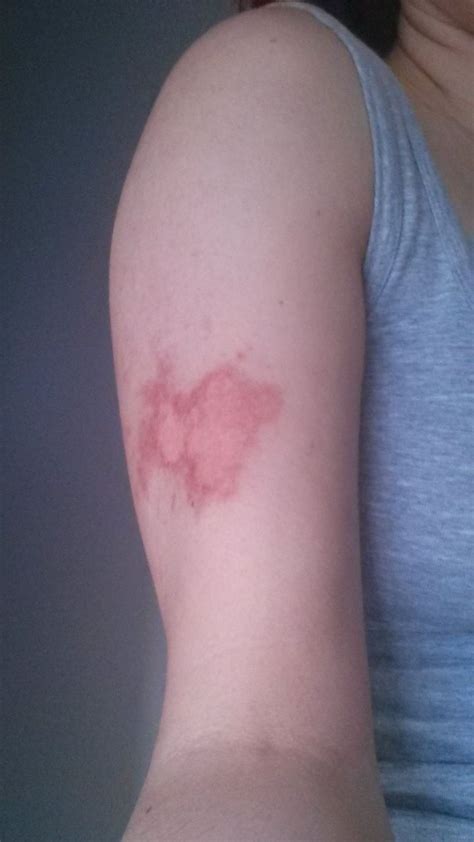 Lupus Rash On Upper Arms