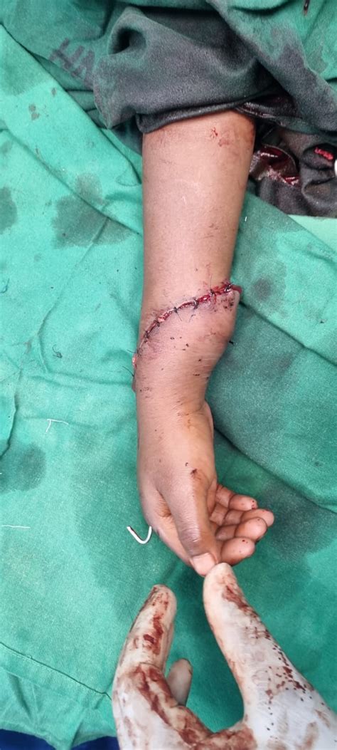 Hand Re Implantation Surgery Department Of Surgery