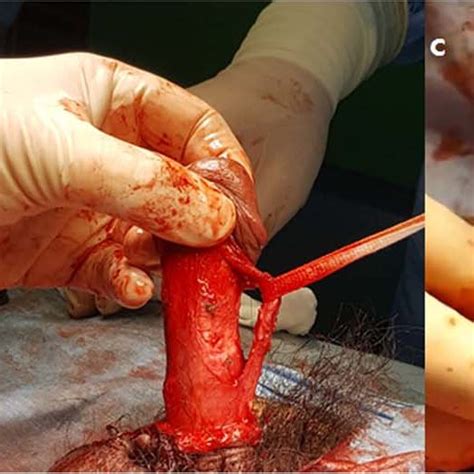 Doppler Ultrasound Image Of The Cavernosal Artery And Velocity