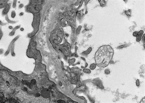 Glomerular Basement Membrane Em