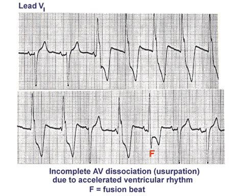 Ecg Learning Center An Introduction To Clinical Electrocardiography