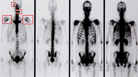 My Bone Scan Results Youtube