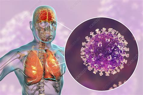 Encephalitis Caused By Nipah Viruses Illustration Stock Image F022