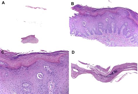 Pathology Of The Nail Unit Dermatologic Clinics