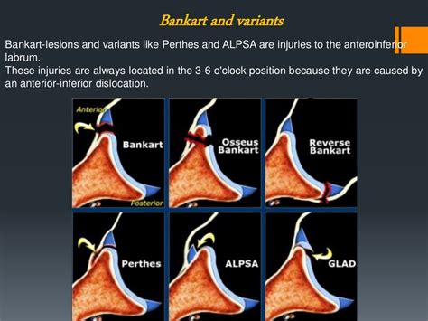Shoulder Labral Tears Mri