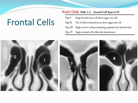 Ppt Principles Of Functional Endoscopic Sinus Surgery Powerpoint