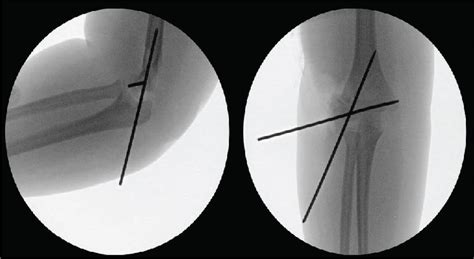 Open Reduction And Pinning Of Lateral Condyle Fractures Journal Of