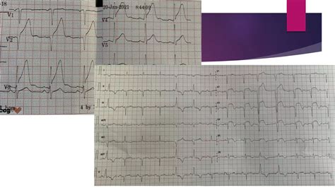 Ecg Localization Of Myocardial Infarction Pptx