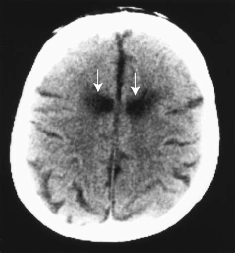 Alteration Of Intention And Self Initiated Action Associated With