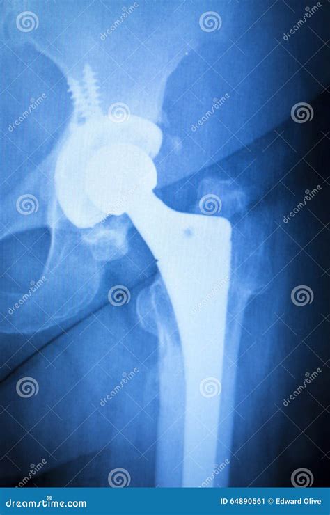 Titanium Hip Replacement And Mri At Samuel Goggins Blog