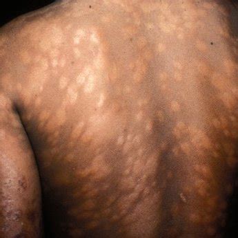 Leprosy Symptoms Pictures
