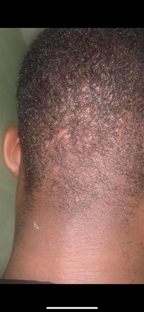 I Have Had These Bumps On The Back Of My Head For A While Now The First