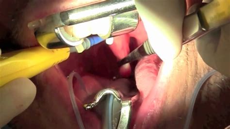 Throat Uvula Surgery