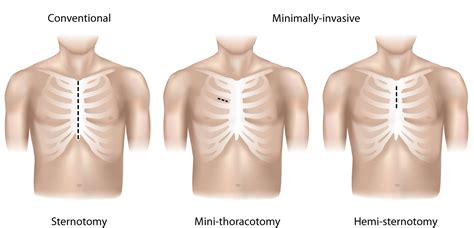 Minimally Invasive Aortic Valve Surgery Ucsf Department Of Surgery