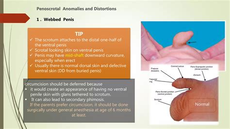 Pediatric Circumcision Lecture Pptx
