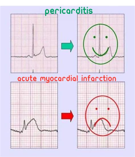 Pericarditis Medizzy