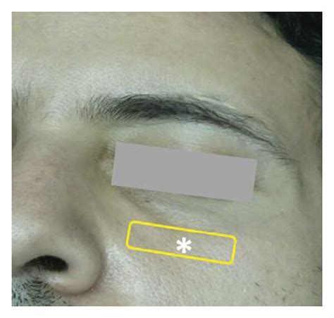 Sonoanatomy And Ultrasound Guided Injection Technique For The