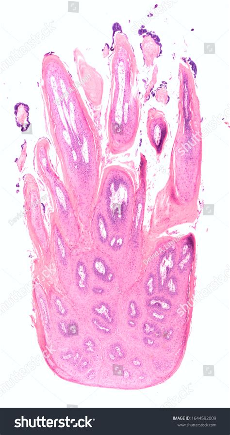 Microscopic Image Squamous Papilloma Benign Lesion Stockfoto 1644592009