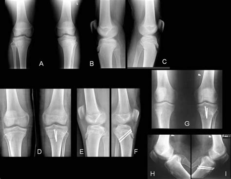 Simultaneous Bilateral Flexion Type Salter Harris Ii Fractures Of The